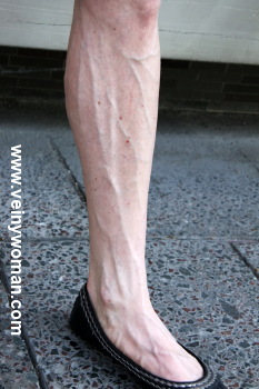 veinywoman.com